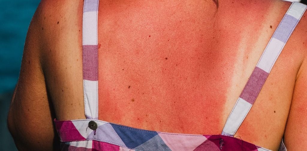 How to treat sunburn pain, according to skin experts