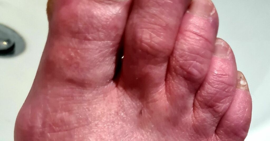 Woman shares horrific photo of severe 'Covid foot'…