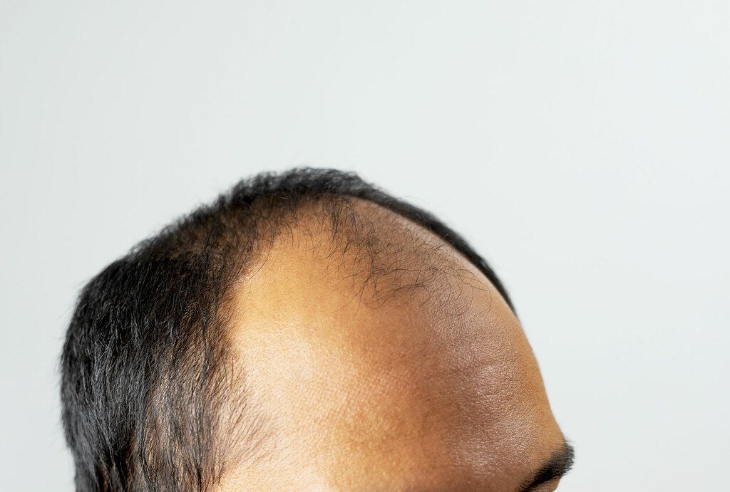 Why, where and how we go bald