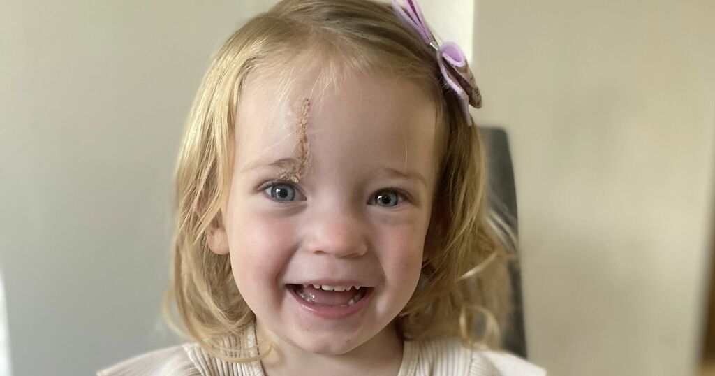 Toddler, two, left with facial scars after metal fence…