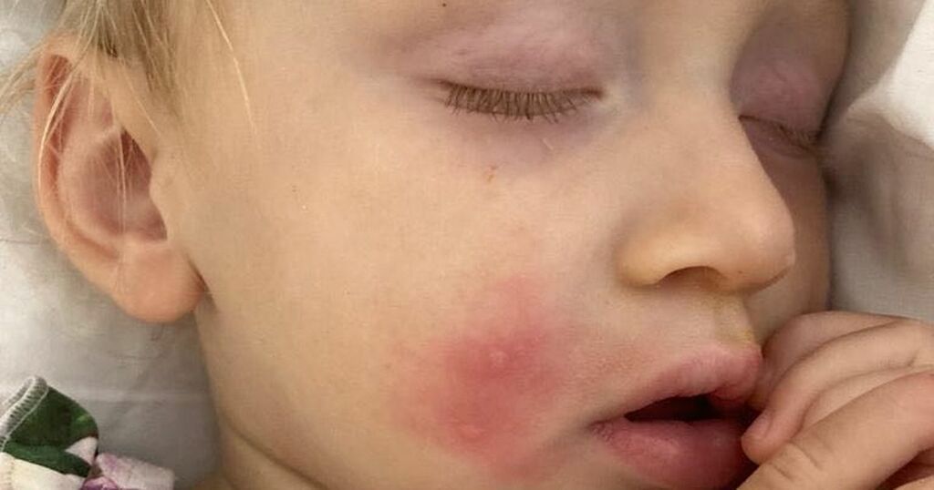TUI hotel bed bug 'infestation' left mum's little girl…