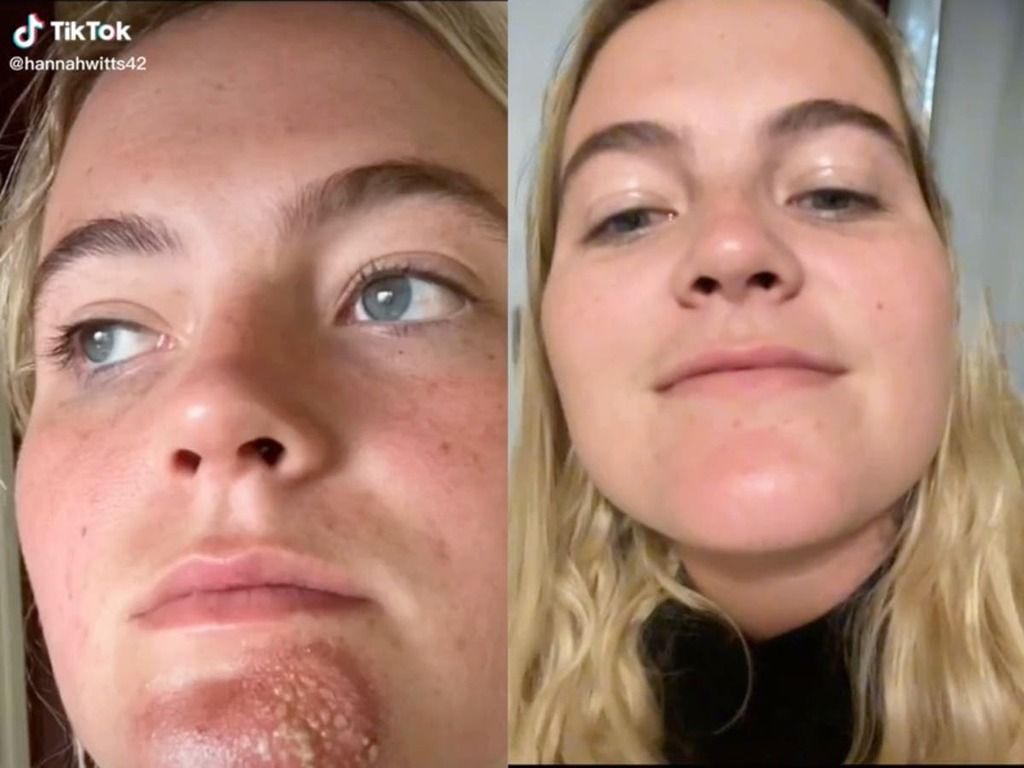 Woman shows chin infection reportedly caused by…