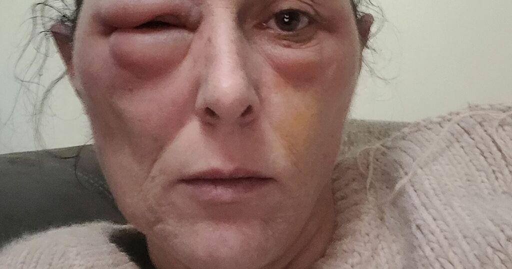 Mum 'looked like Elephant Man' as her head swelled up…