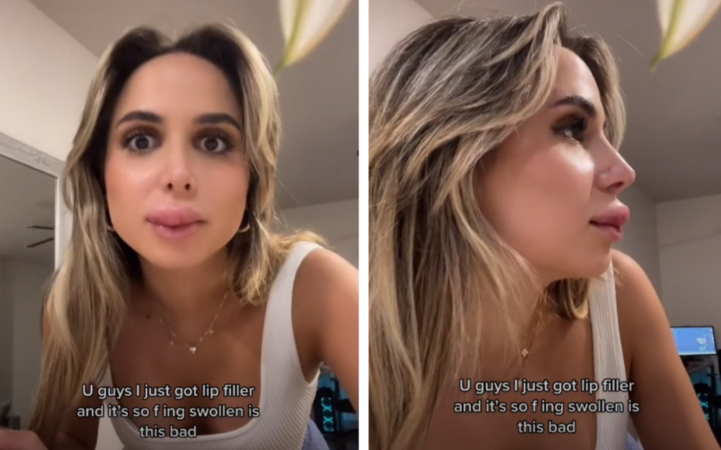 Woman compared to ‘the Grinch’ after showing lip…