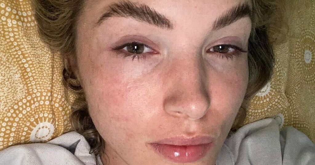 Former Miss Universe experiences rare Covid symptom…