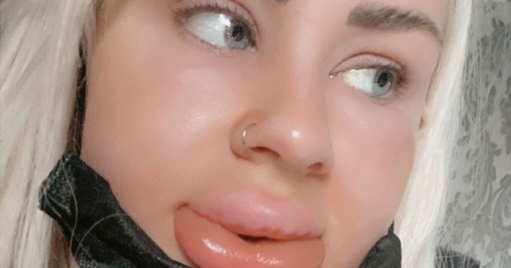 Scot left with 'sausage lips' after horror allergic…