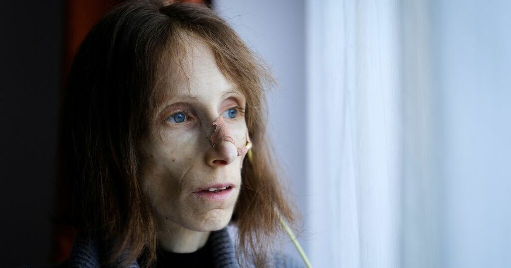 Woman starving to death due to rare condition dies…