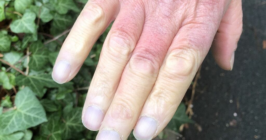 Raynaud's disease awareness month: Signs and symptoms…