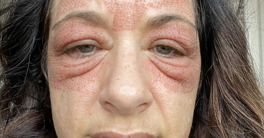 Mum's face balloons after spending £800 on treatment…