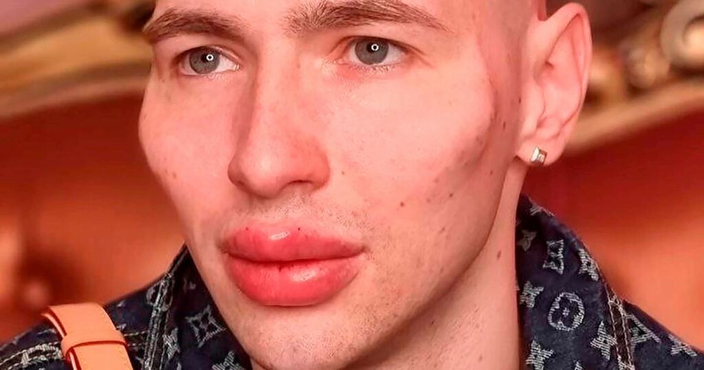 Russian 'Popeye' ignores doc death warning to undergo…