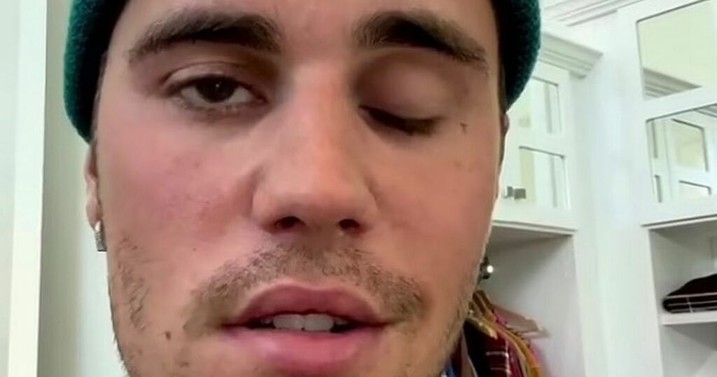 Justin Bieber has been struck by facial paralysis from…
