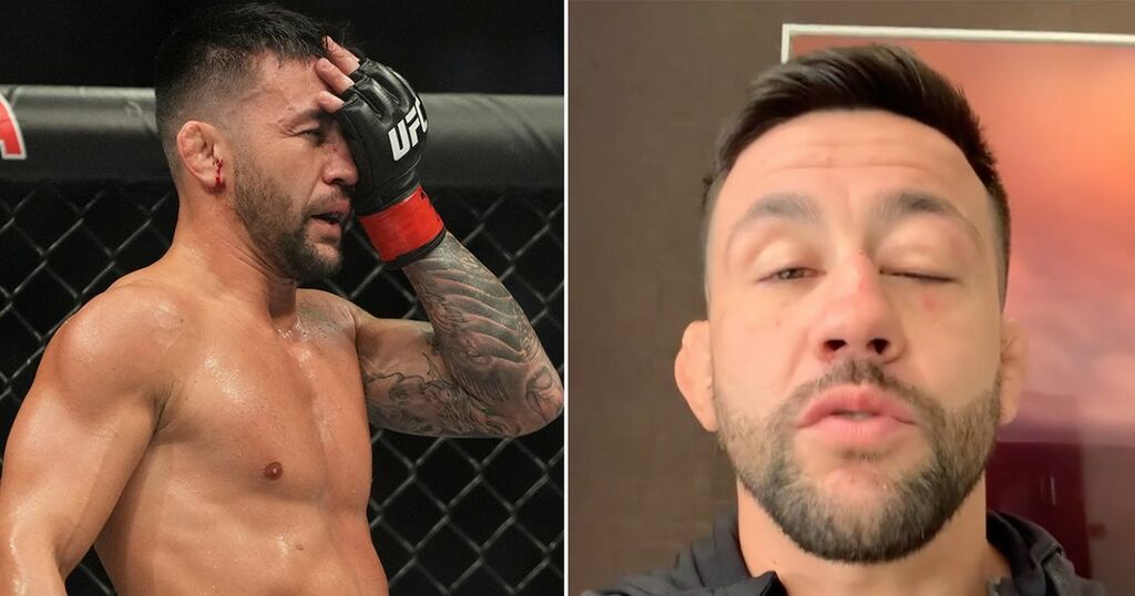 UFC star left with one eye shut after being blinded by…