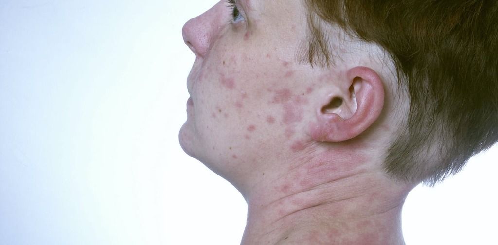 What causes hives and how dangerous can they be? A…