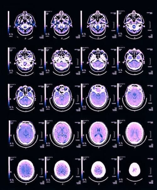 Brain signatures tied to appetite could reveal new…