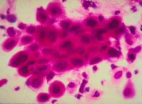 Modified herpes virus shows promise killing off cancer…