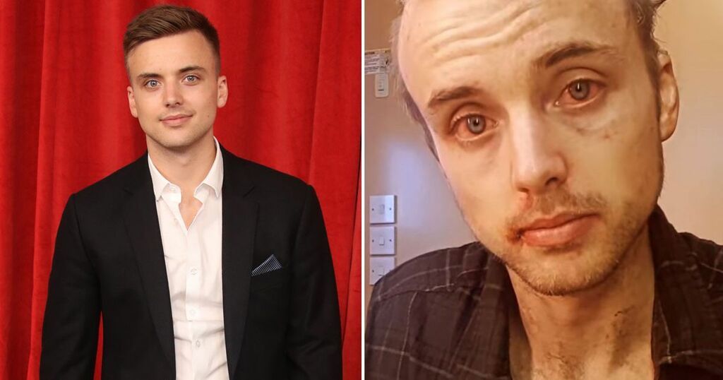 Hollyoaks' Parry Glasspool unrecognisable after losing…