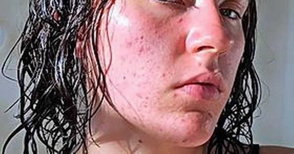 Student with severe acne fights back after being…
