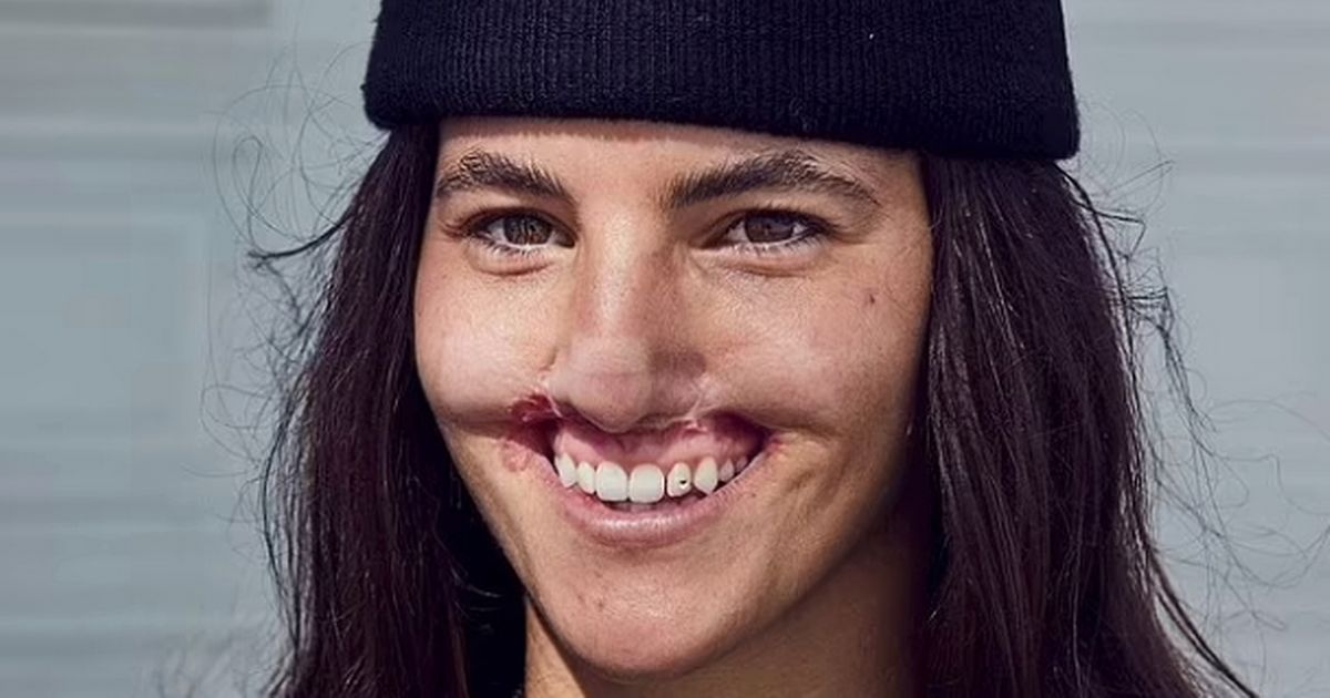 Model with lip ripped off by dog looks unrecognisable…