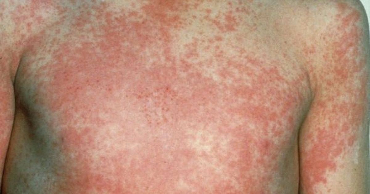 Scarlet fever symptoms as Strep A bacteria 'still…