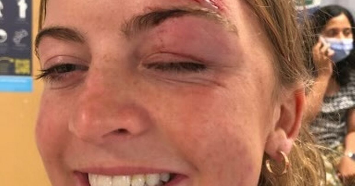 Unlucky bride hit with baseball days before wedding…