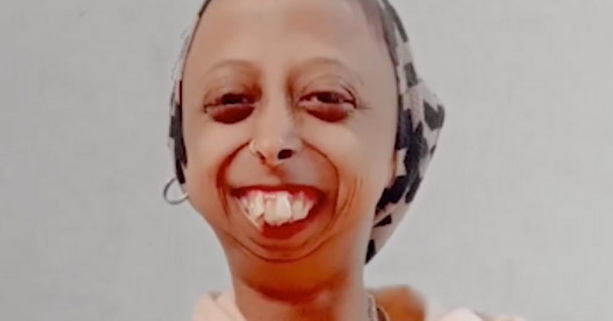 Woman with rare condition leaving her with no chin…