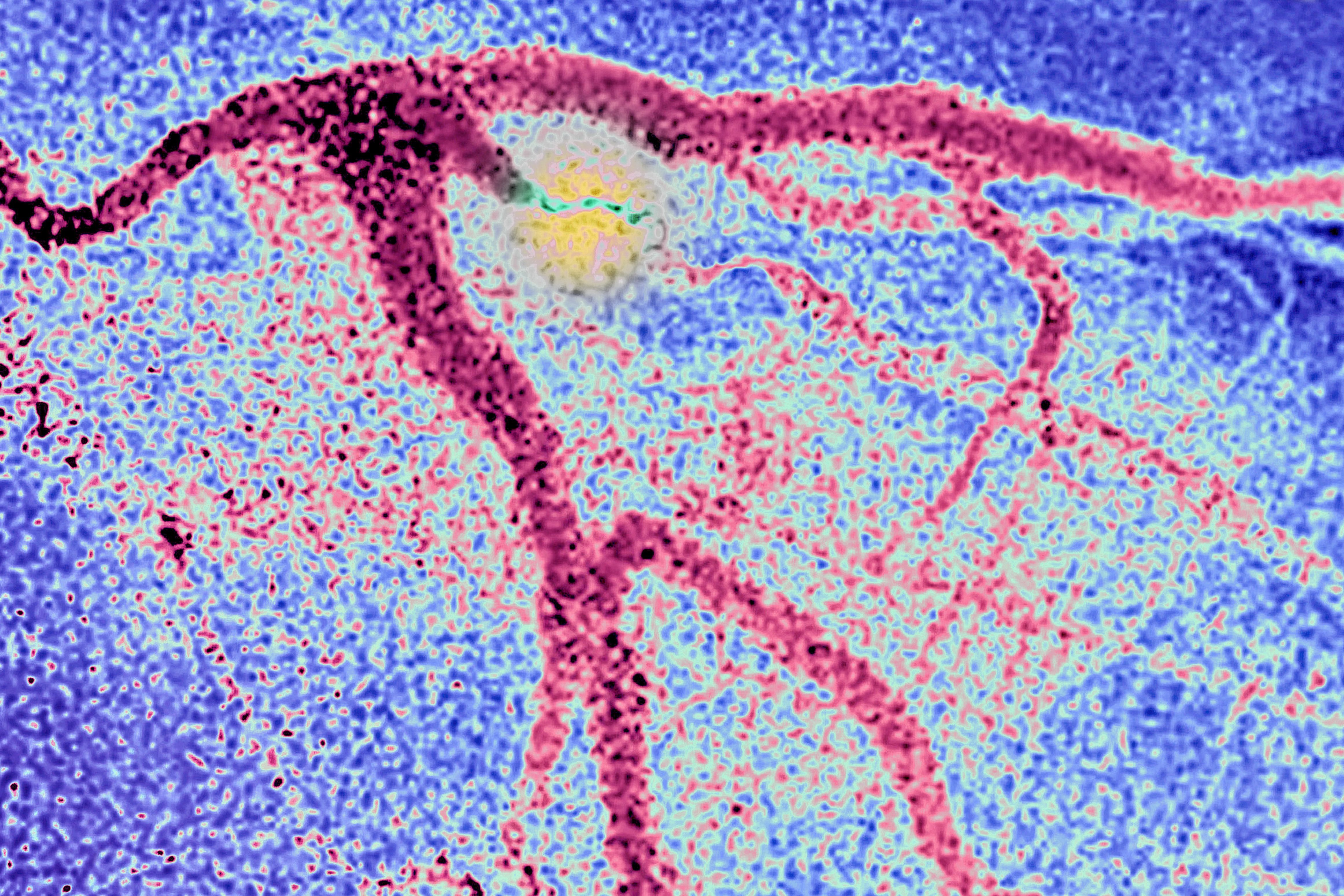 High-Tech Scans Can Identify Heart Attack Risk Years…