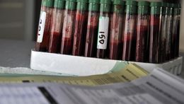 Hannah Quinn Mulligan The Welfare Cost Of TB Tests