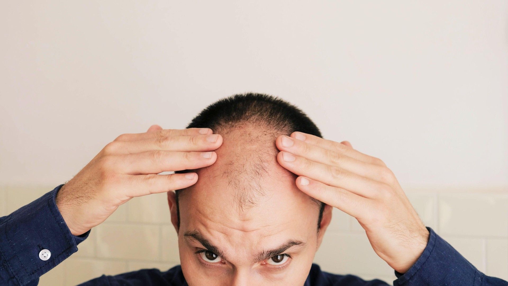 What is 'male pattern baldness'?