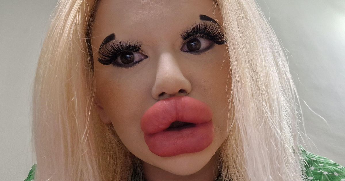Woman with 'world's biggest lips' can't find 'love of…