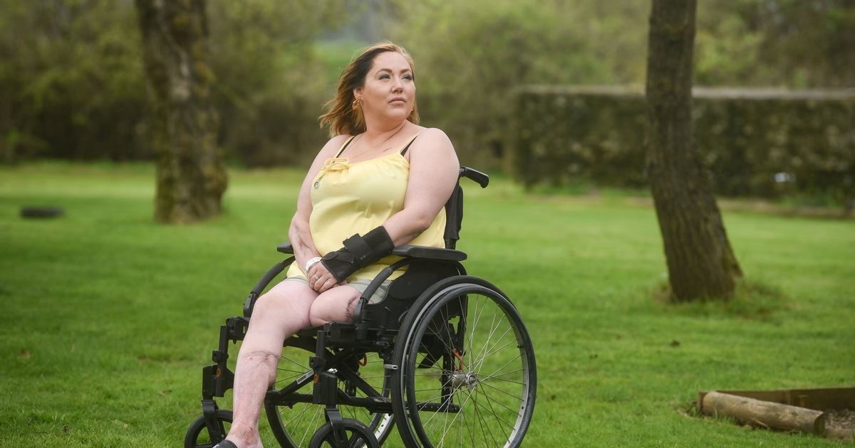 Runner Has Leg Amputated After Contracting…