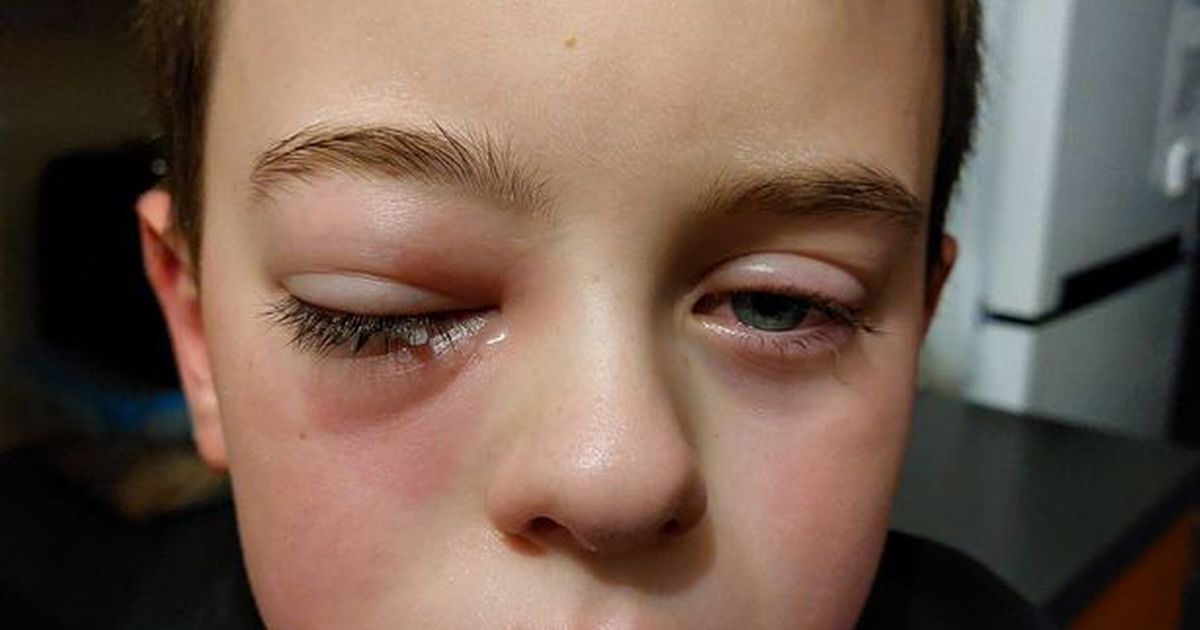 Carluke schoolboy nearly 'loses eye' after severe…