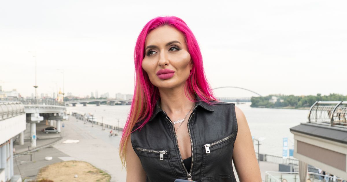 Model with 'world's biggest cheeks' candidly shares…