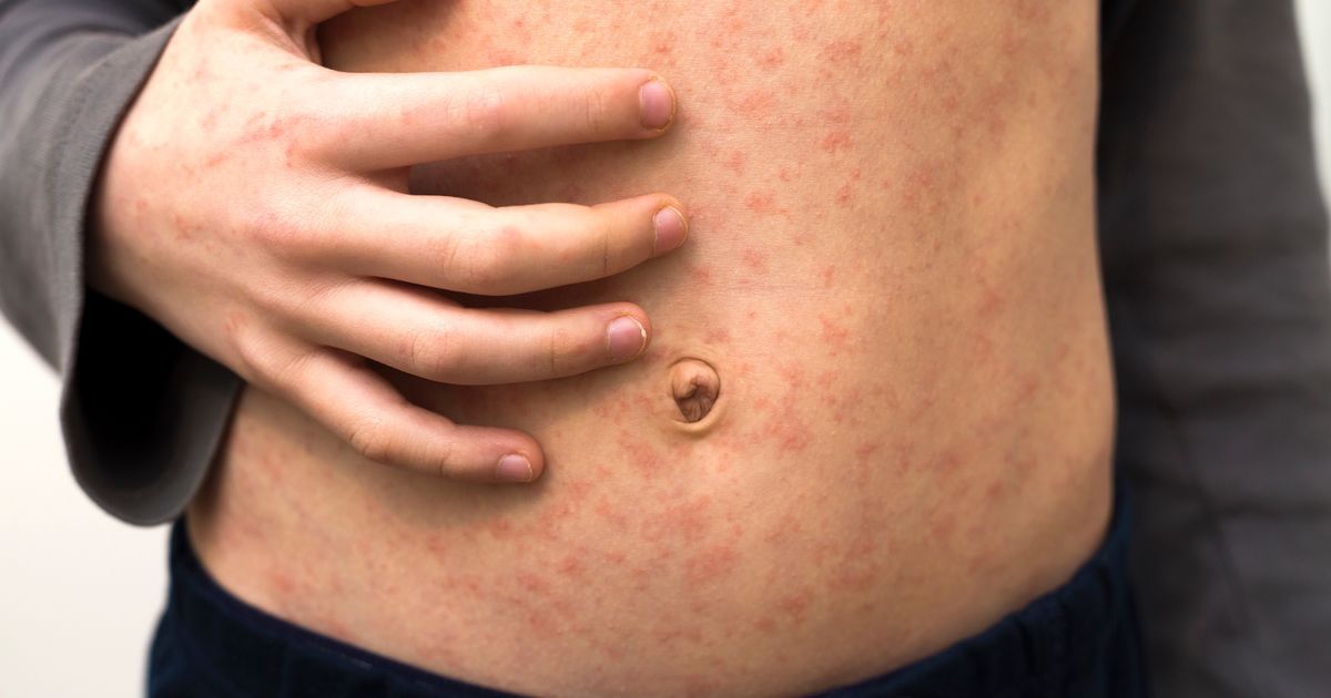 Measles symptoms: Seven key warning signs of highly…