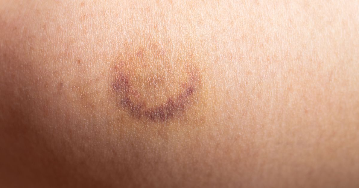 Four blood cancer red flags people should never ignore…