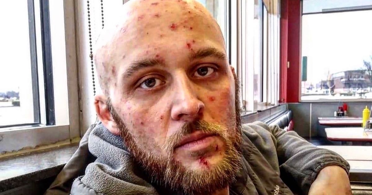 'Opioid zombie' dad from 'overdose capital of US'…