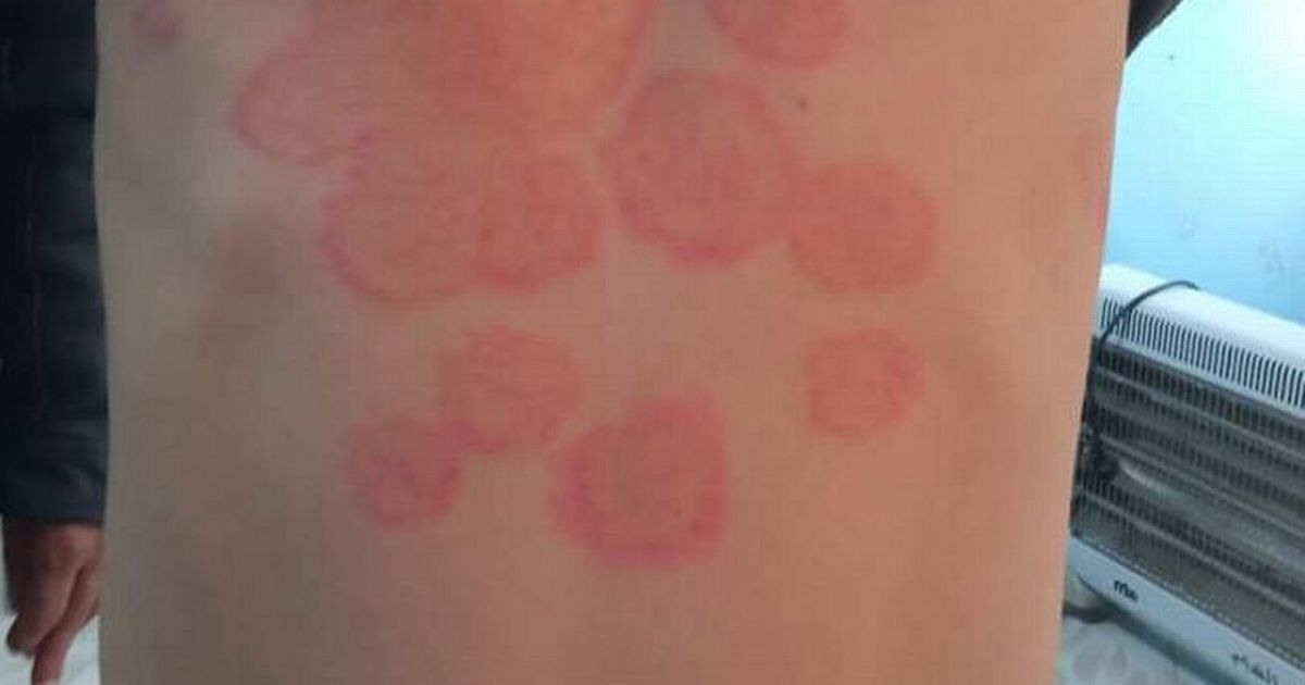 Mum's fungal disease horror as doctors warn it could…