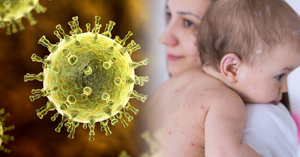 Chickenpox myths busted including why you SHOULDN'T…