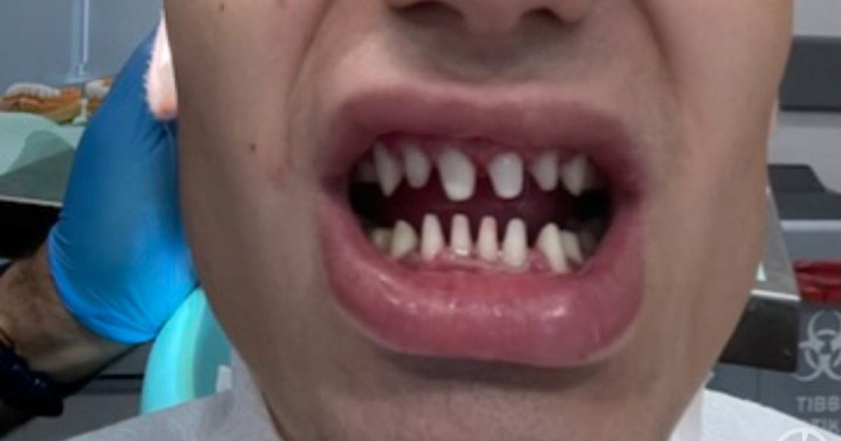 Model left looking like 'shark in horror movie' after…