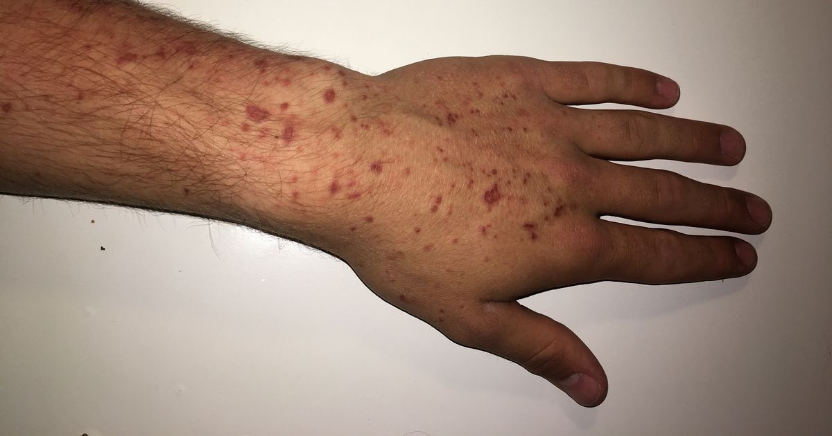 Giant hogweed warning as doctor explains 'nasty'… Giant hogweed warning as doctor explains 'nasty'…