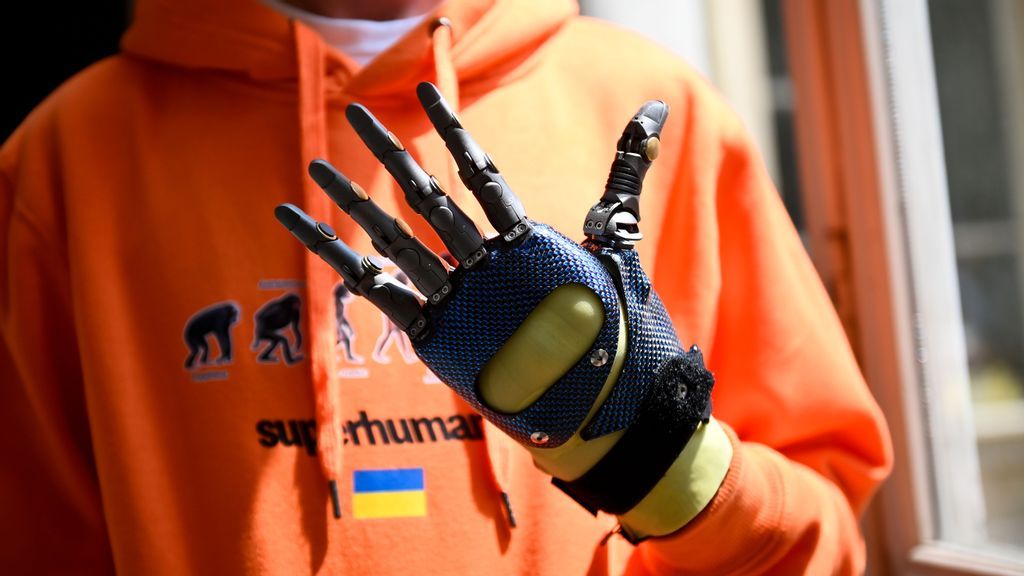 Student Creates Affordable 3D-printed Prosthetic Hand
