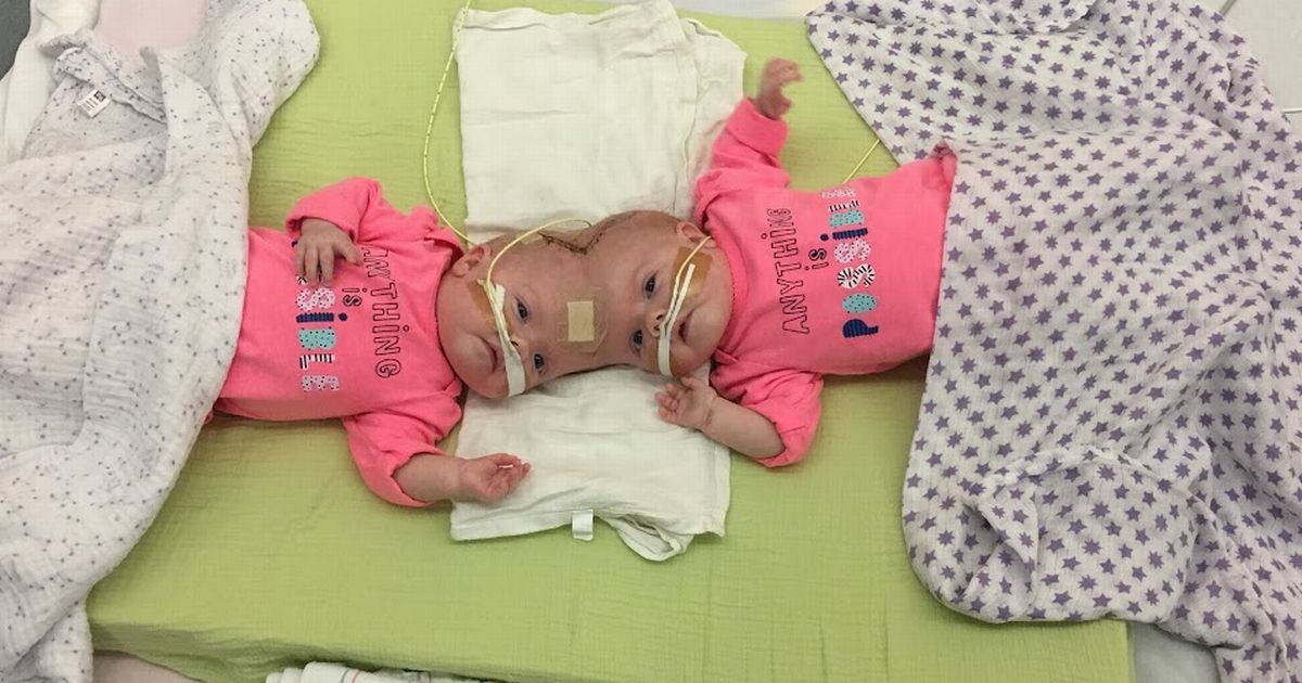 Conjoined twins survive separation surgery despite 2…