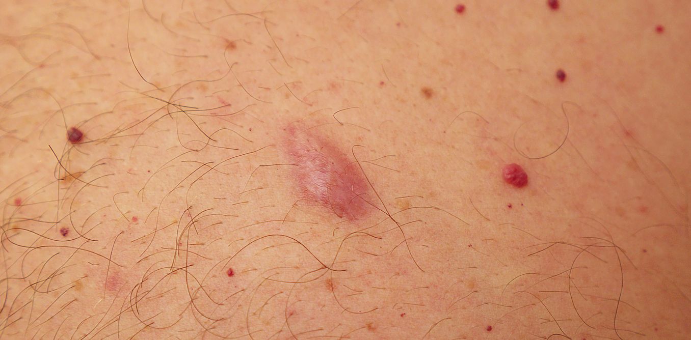 Common lumps and bumps on and under the skin: what are…