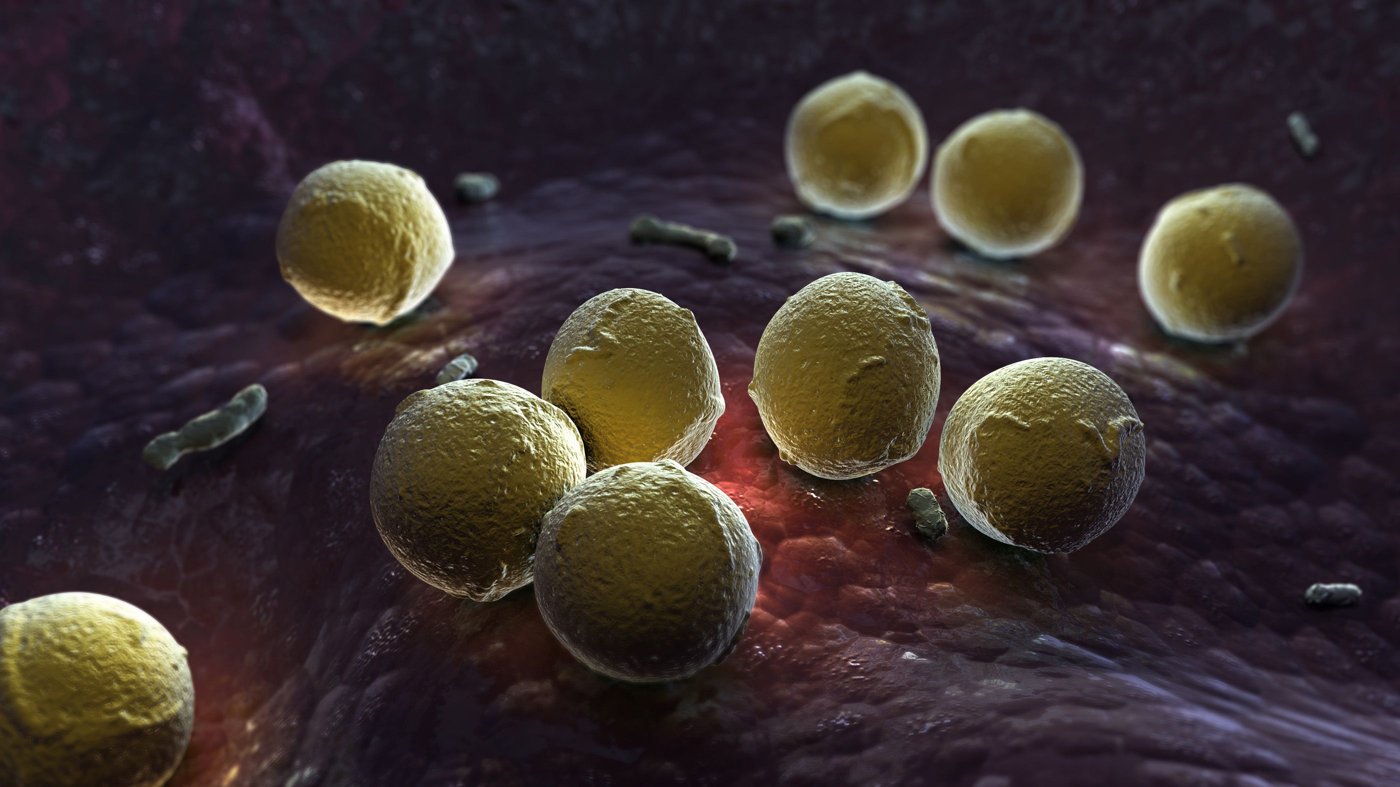 In Rare Case Man Develops Flesh Eating Bacterial…