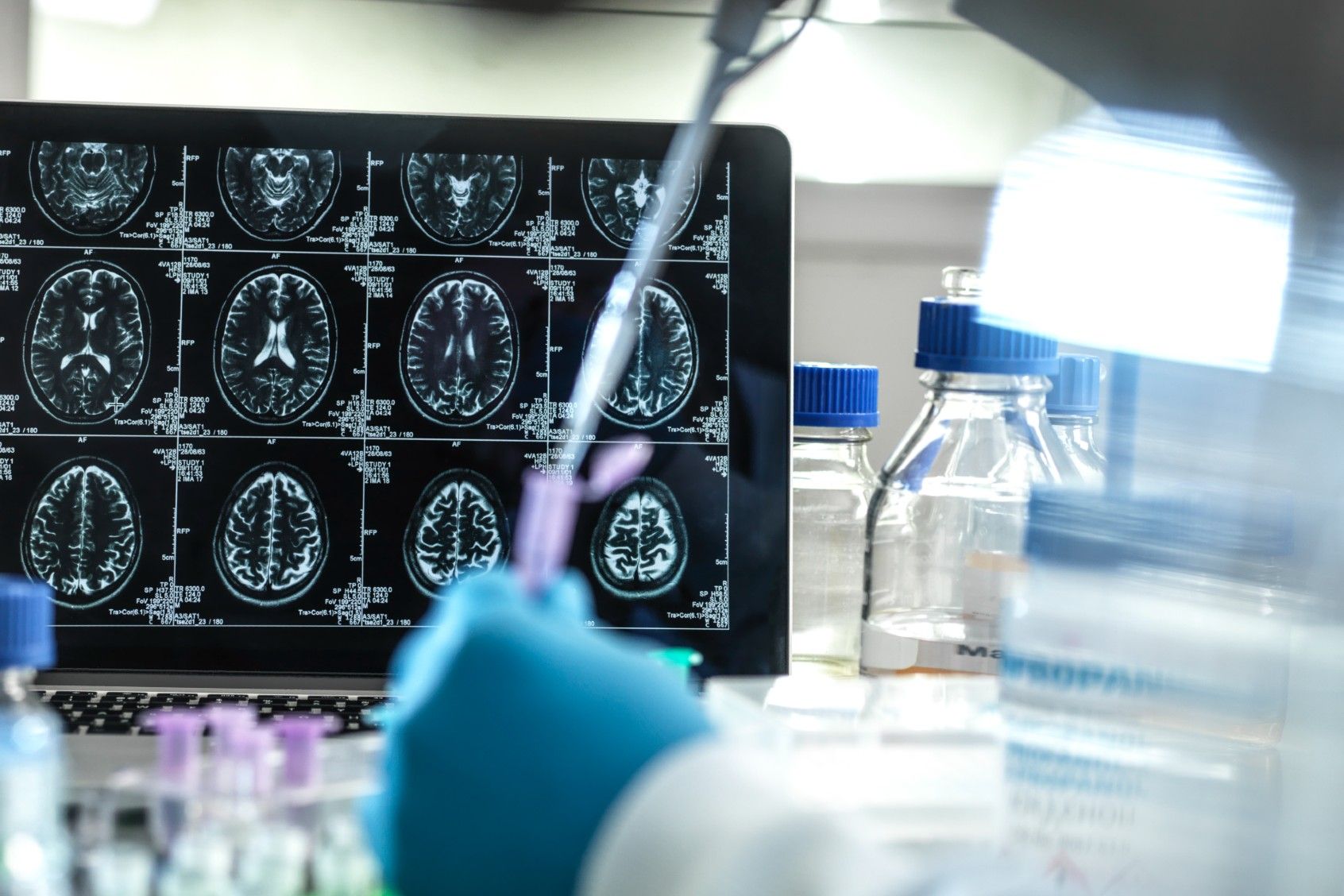 New dementia drug raises hopes and fears