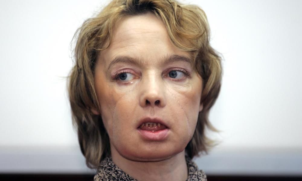 Woman who received the world's first partial face…