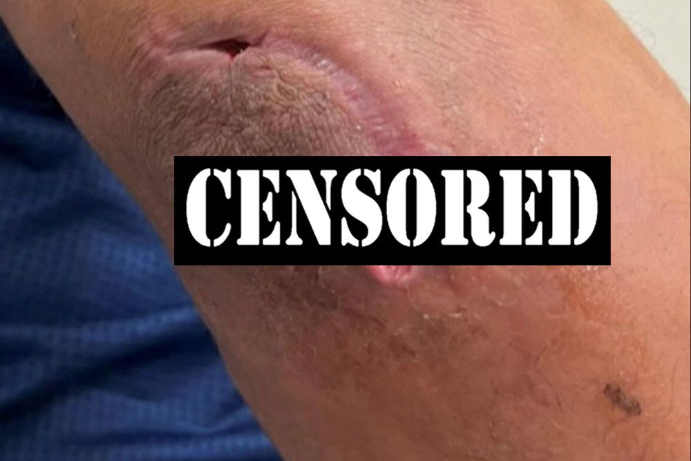 Grisly photo shows severity of Paulo Costa’s staph…