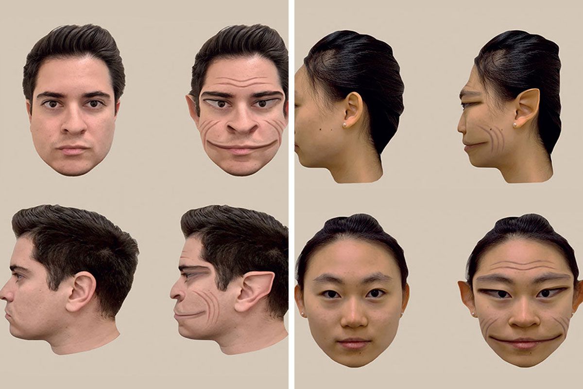 Man With Rare Disorder With Less Than 100 Reported…