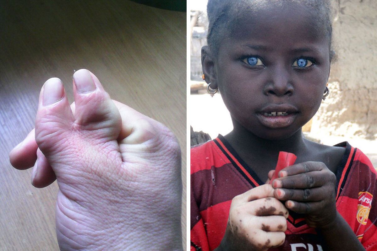 89 Photos Of Unique People That Show That Genetics Is…