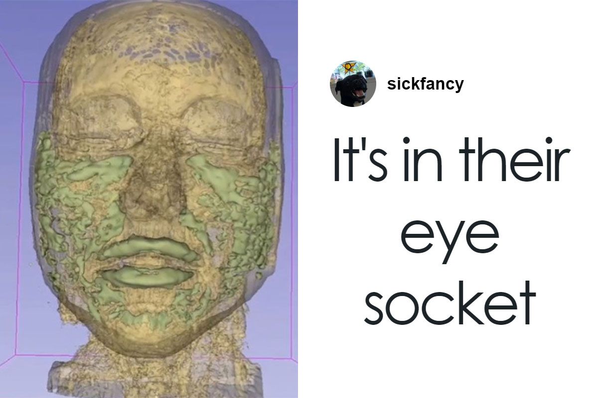 MRI Of 33-Year-Old Woman’s Face Reveals Where All Her…