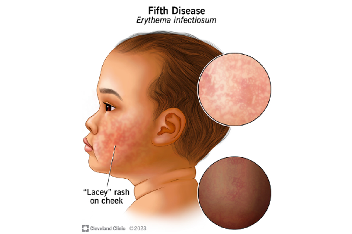 ‘Slapped cheek’ rash-causing virus on the rise among…